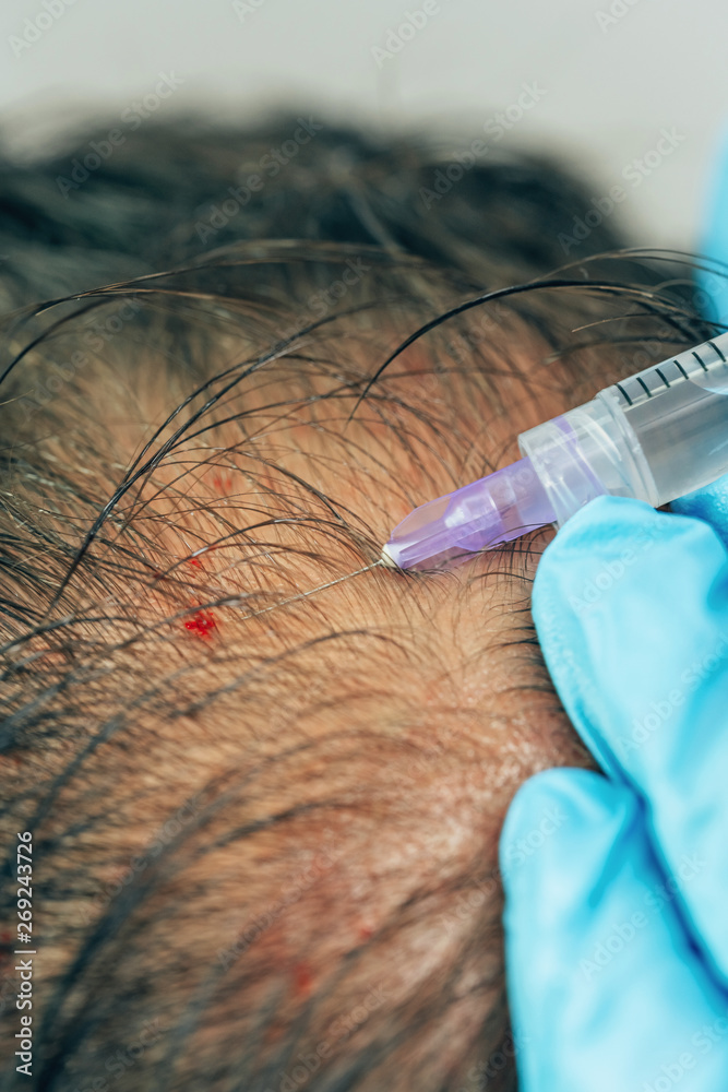 Mesotherapy of hair and head. Injections in the head. Fighting hair ...