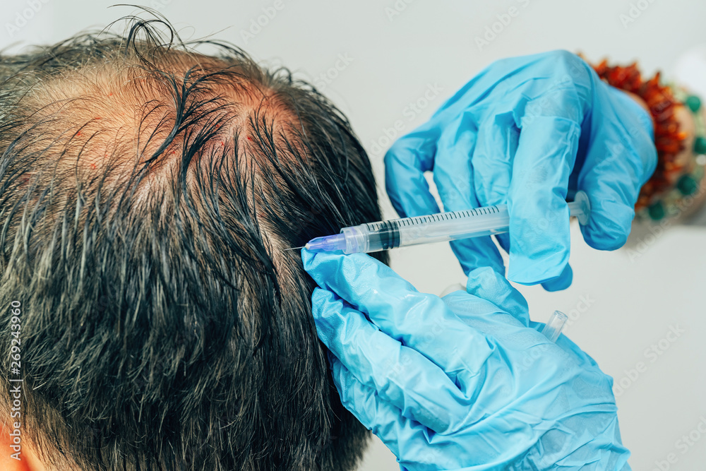 Mesotherapy of hair and head. Injections in the head. Fighting hair ...