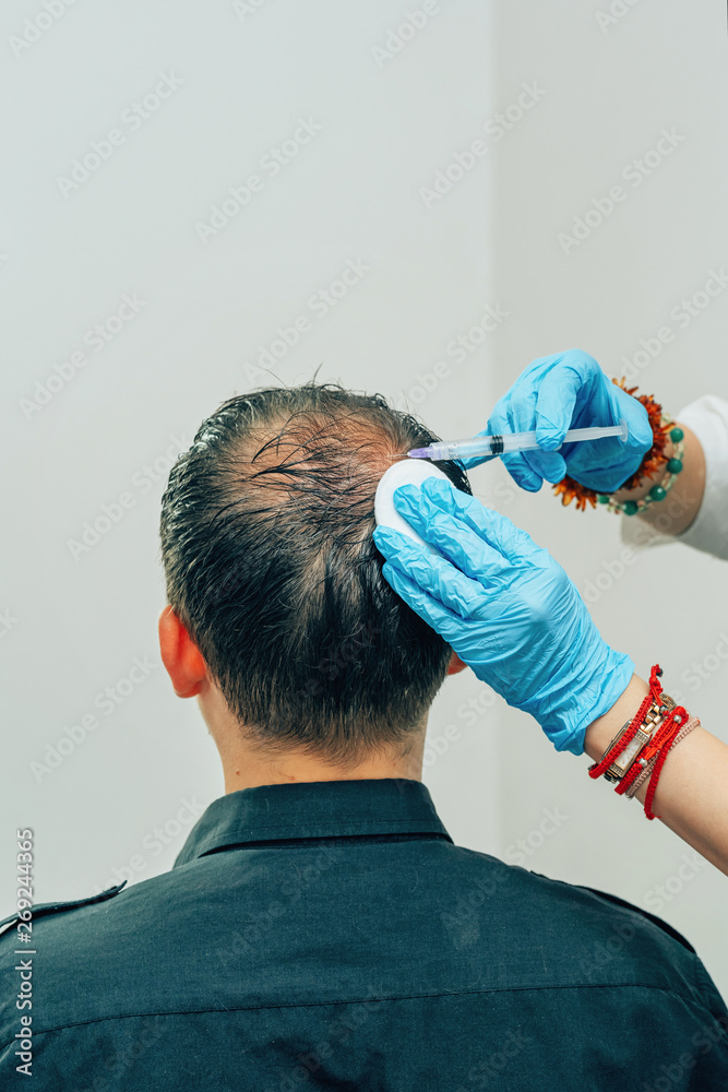 Mesotherapy of hair and head. Injections in the head. Fighting hair ...