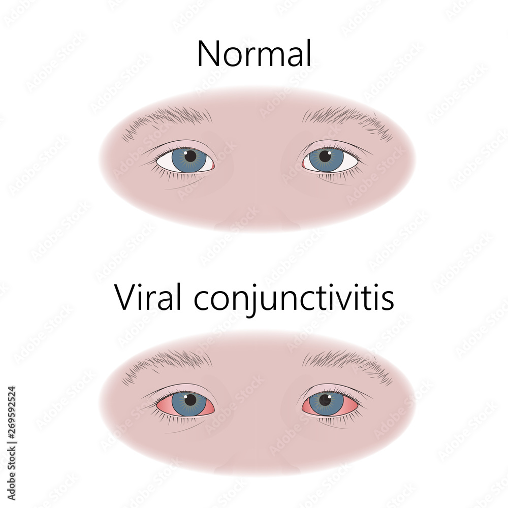 Viral conjunctivitis in infants, kids, child. Virus. Comparison with ...