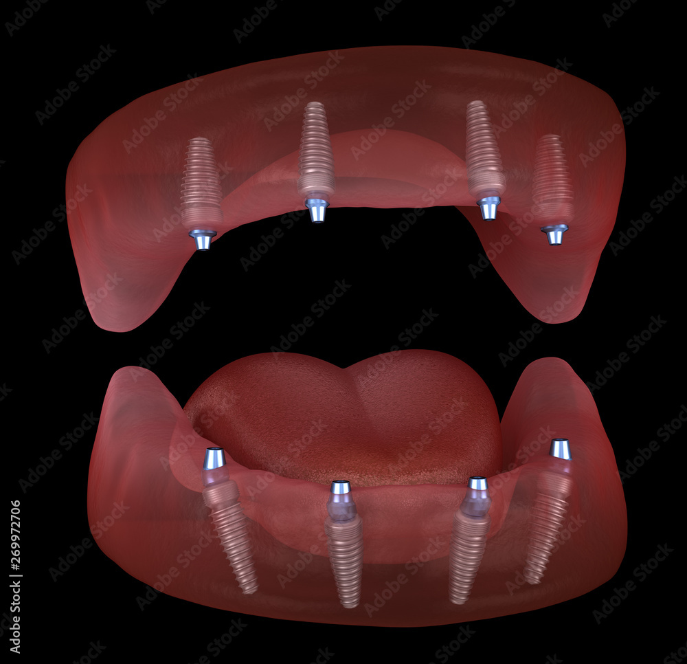 Maxillary and Mandibular prosthesis with gum All on 4 system supported ...