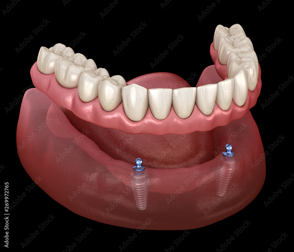 Mandibular removable prosthesis All on 2 system supported by implants ...