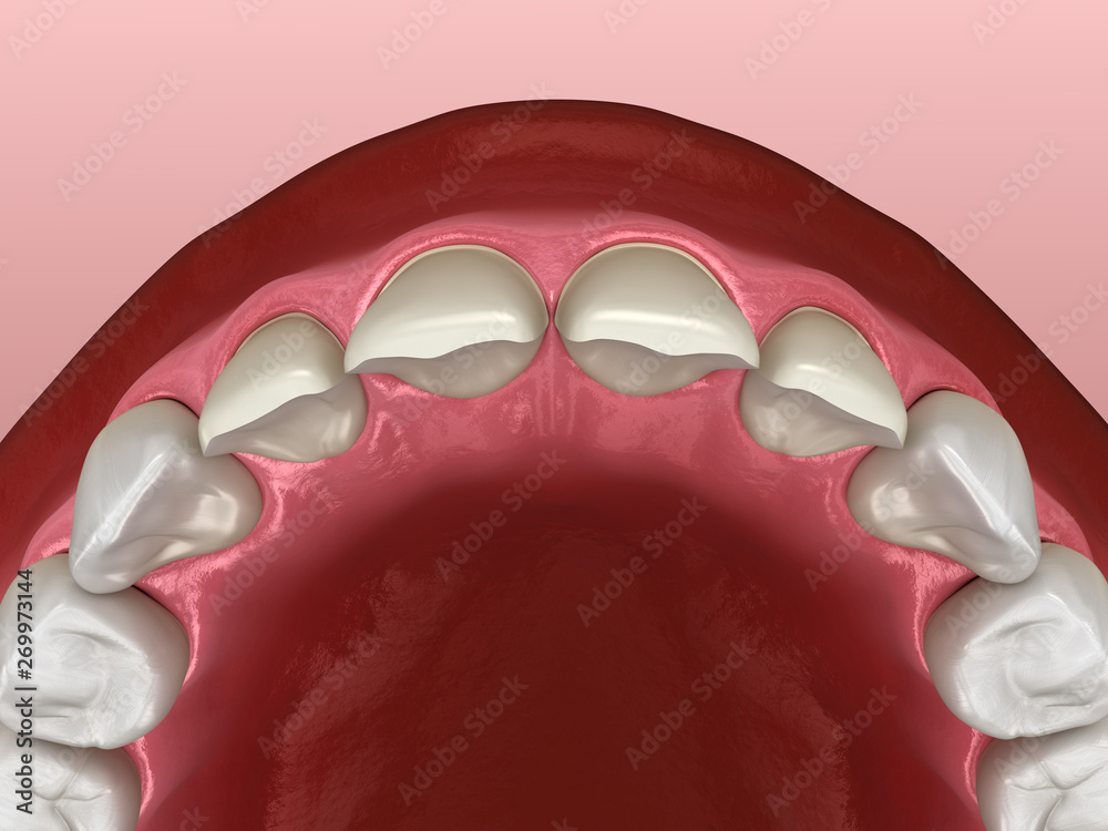 Teeth preparation for Veneer installation procedure over central ...