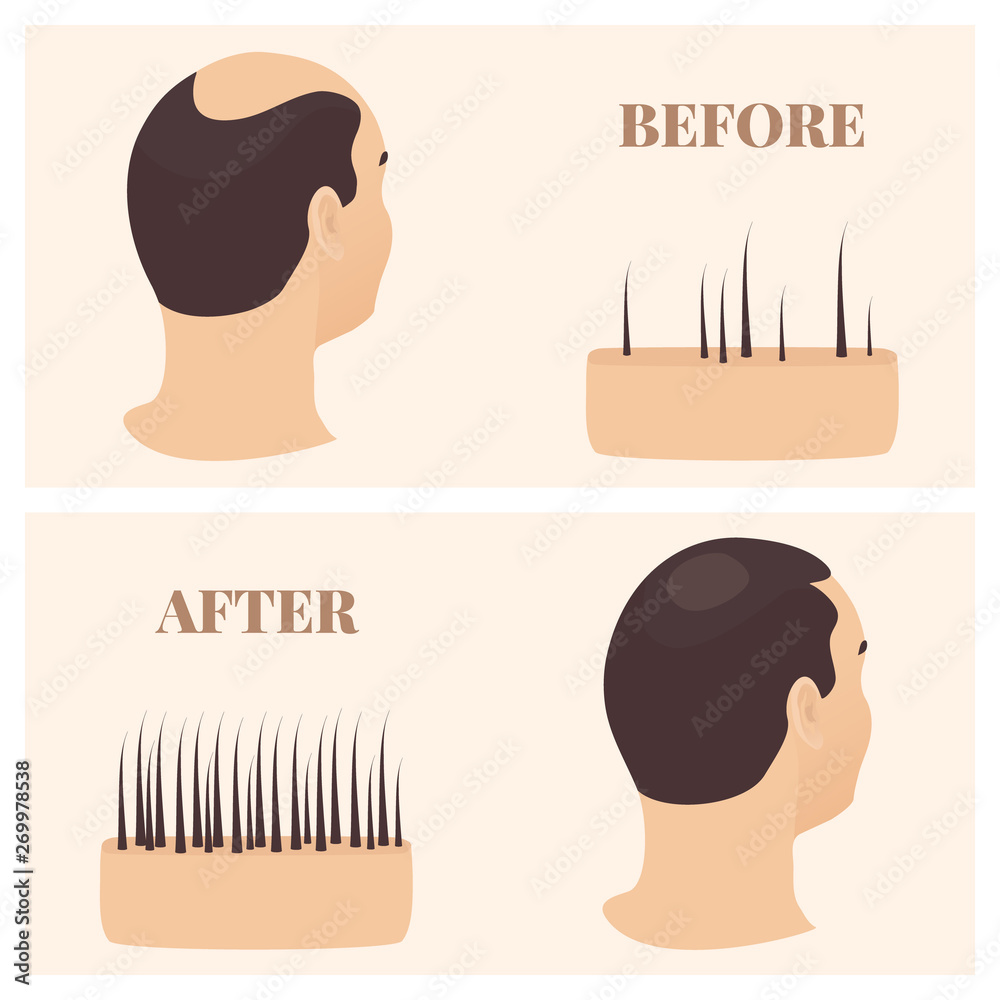 Man with thinning hair before and after hair loss restoration. Male ...