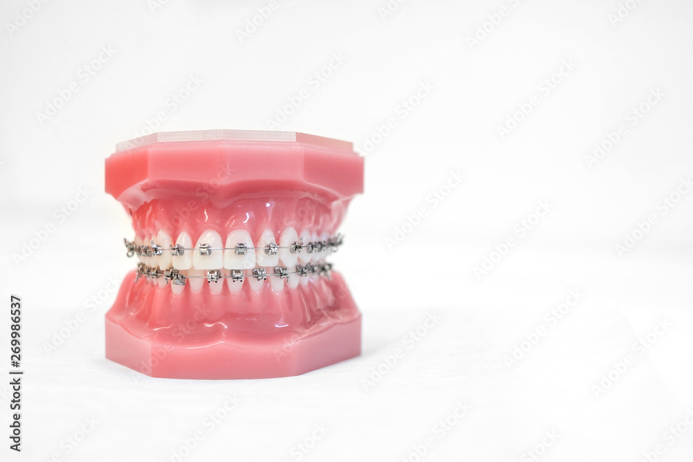 Fotografia do Stock: braces on teeth model of orthodontic bracket or ...