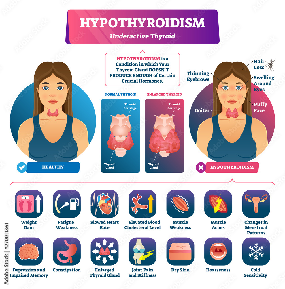 Hypothyroidism vector illustration. Labeled underactive thyroid ...