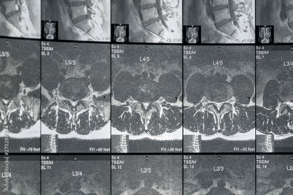Poster MRI scan of sacro lumbar spines of a patient – Wall Art | UkPosters