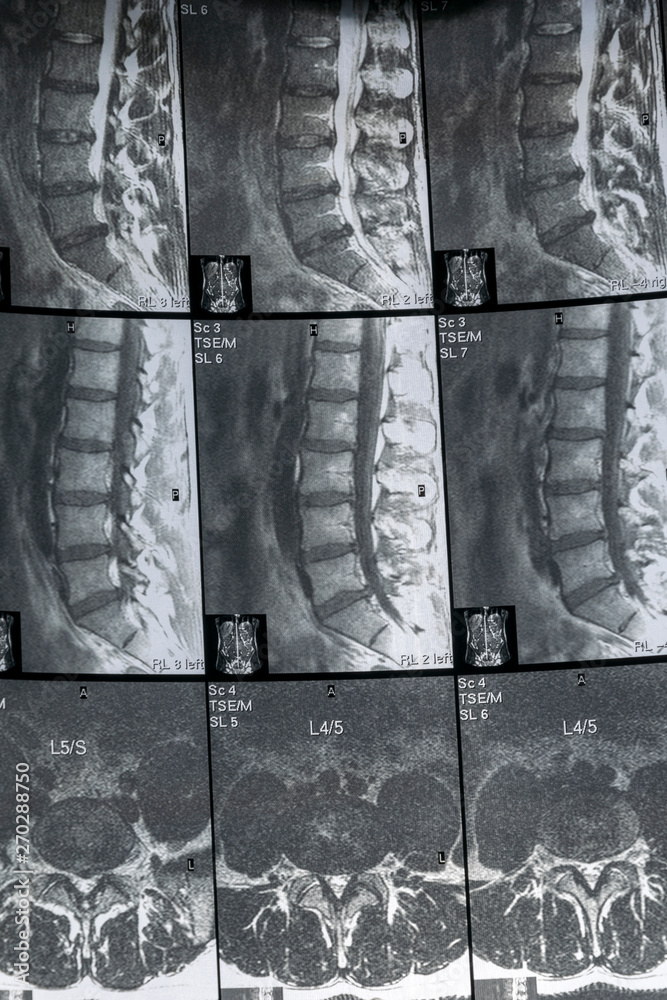 MRI scan of sacro lumbar spines of a patient. the Magnetic Resonance ...