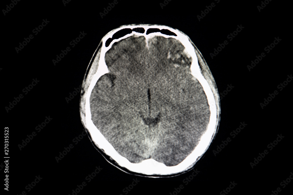 CT brain scan of a patient with bilateral hemorrhagic contusion Stock ...