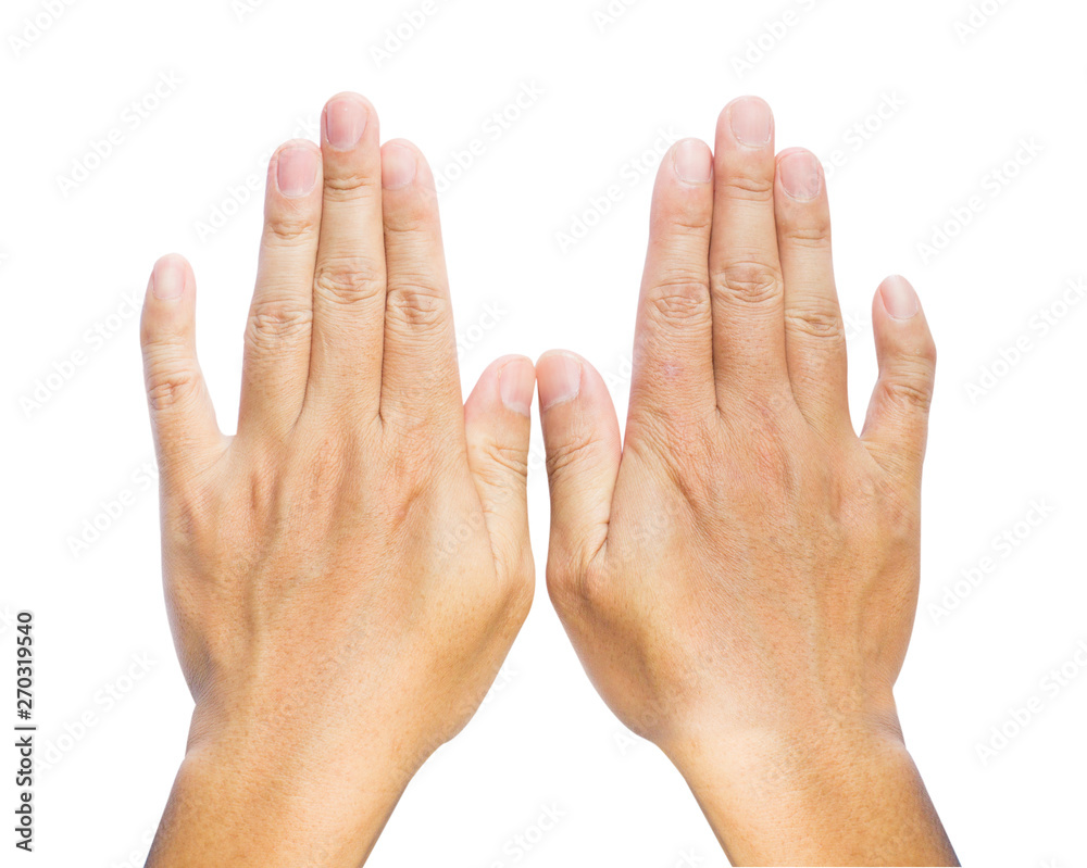 clinodactyly fingers isolated on white background isolated fifth finger ...