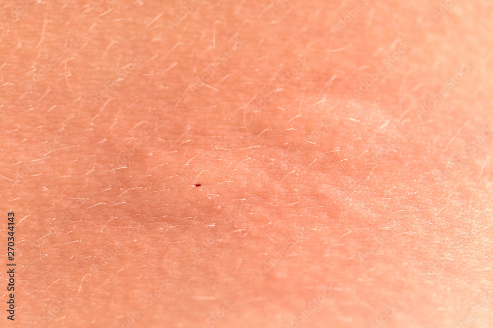 Swollen skin after a mosquito bite. Blisters appeared at the site of ...