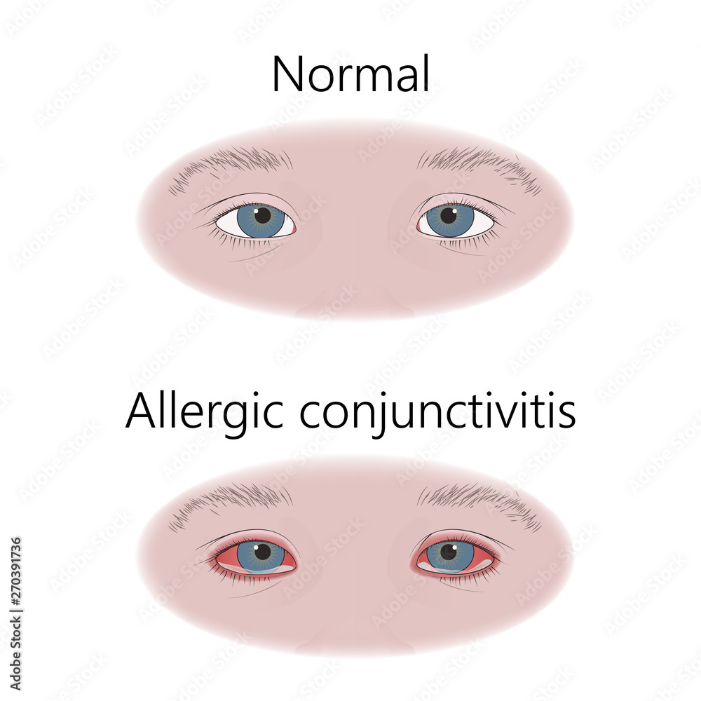 Allergic conjunctivitis. Allergy. Comparison with normal. flat medical ...