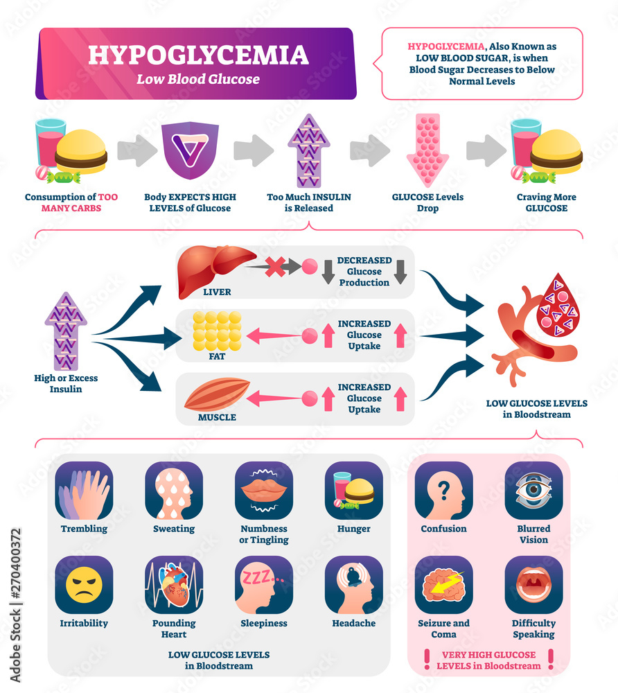 Hypoglycemia vector illustration. Labeled low sugar level medical ...