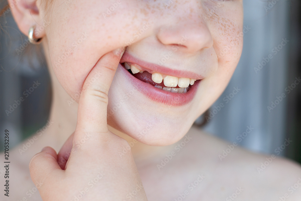 Cute little girl lost milk tooth Stock Photo | Adobe Stock