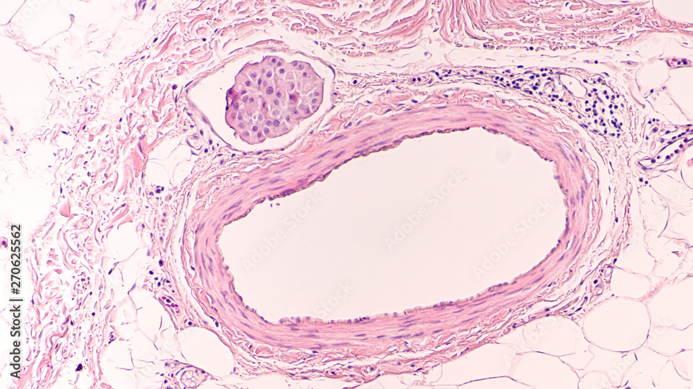 Photomicrograph showing vascular (lymphovascular) invasion of breast ...