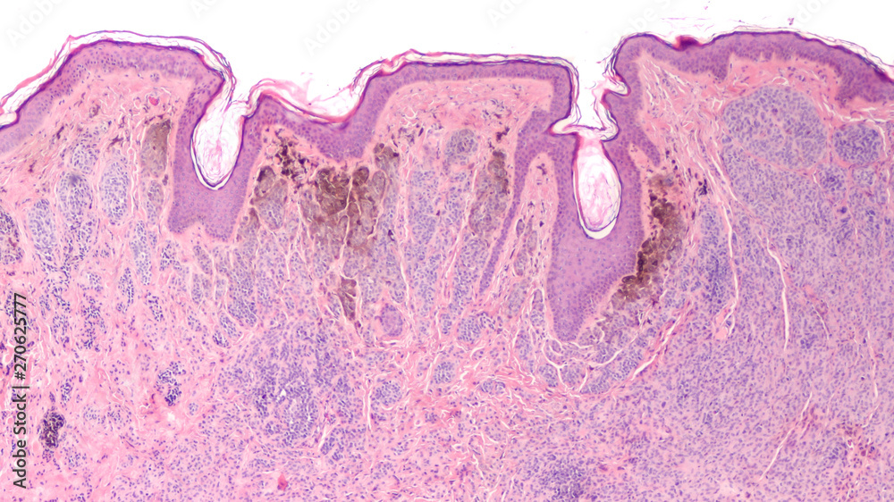 Photomicrograph of a skin biopsy showing histology of an intradermal ...