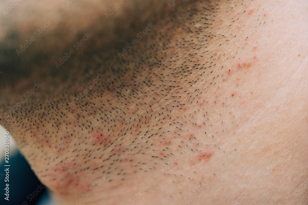 Bristles on the guy's face and neck. Red pimples on the skin ...