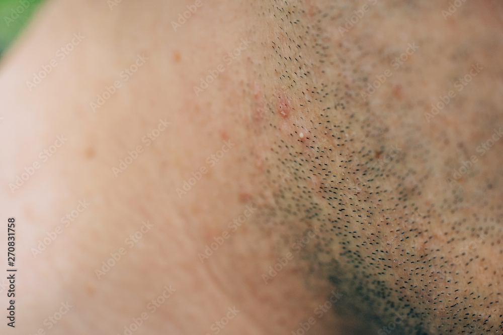 Bristles on the guy's face and neck. Red pimples on the skin ...