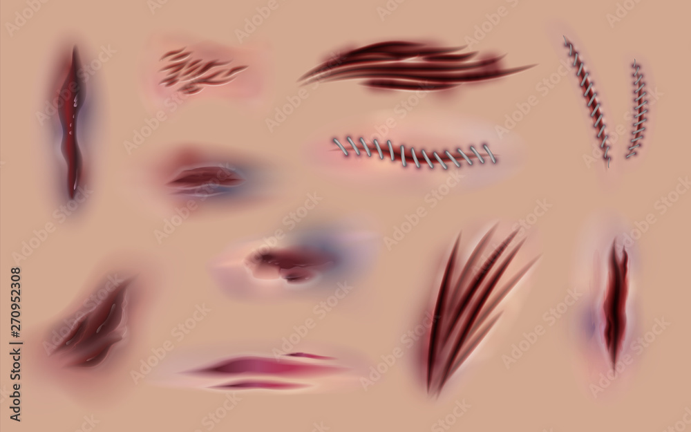 Skin scars and wounds. Surgery stitches and horror wounds on skin ...