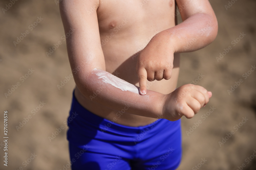 Sunburn. Suncream. Child got sunburn in very hot summer days. The child ...