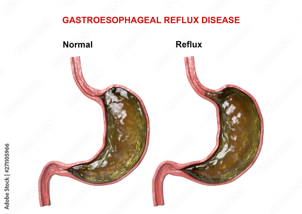 Gastroesophageal Reflux Disease - failure of the digestive mechanism ...