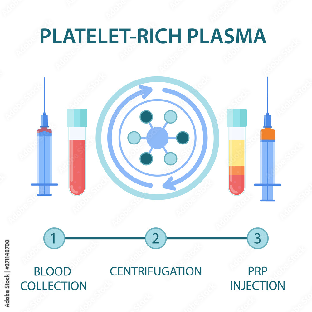Vetor de PRP procedure steps vector infographics. Test tubes and ...