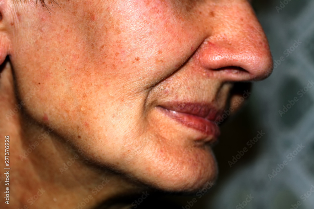 Sunken cheeks. Nasolabial folds on face. Wrinkles. Stock Photo | Adobe ...