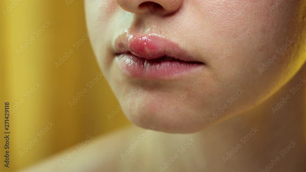 Wideo Stock: Herpes on the Upper Lip of a Young Woman. Medical ...