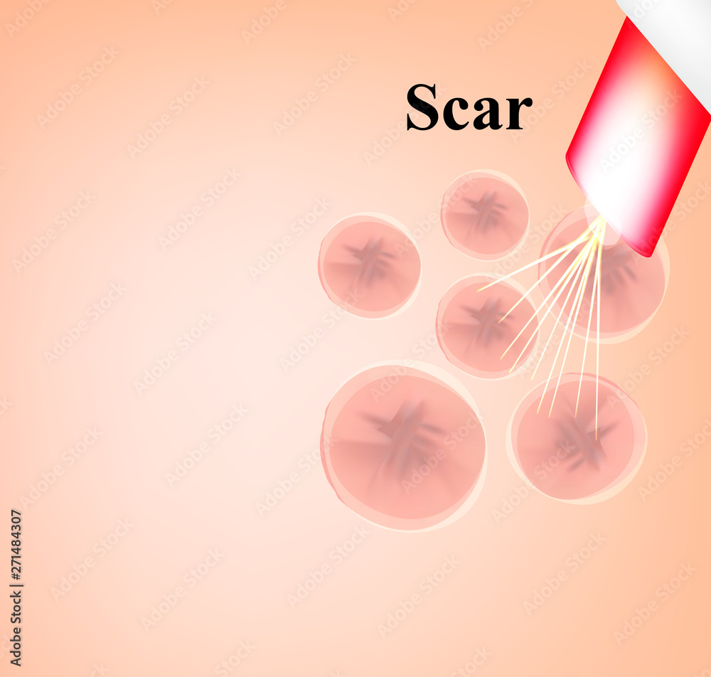 Skin scars after acne and pimples. Treatment of scars on the skin of ...