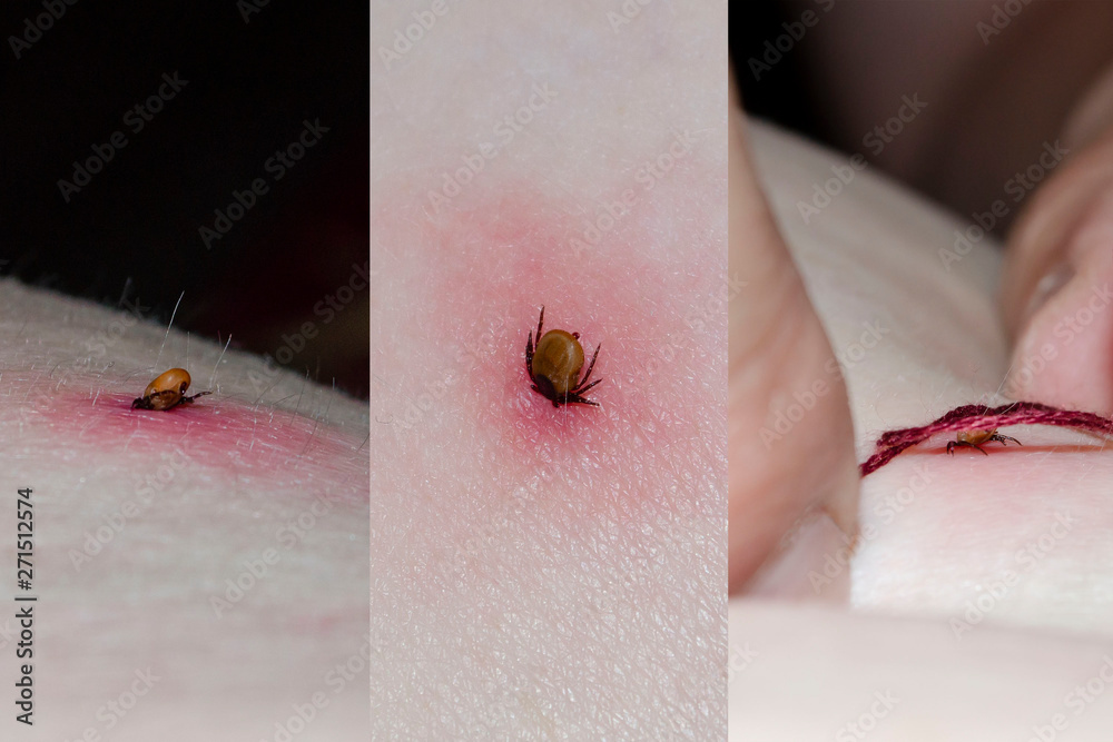 Tick with its head sticking in human skin Stock Photo | Adobe Stock