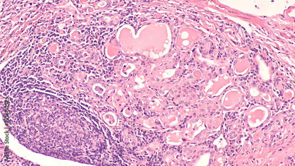 Hashimoto Thyroiditis Histology