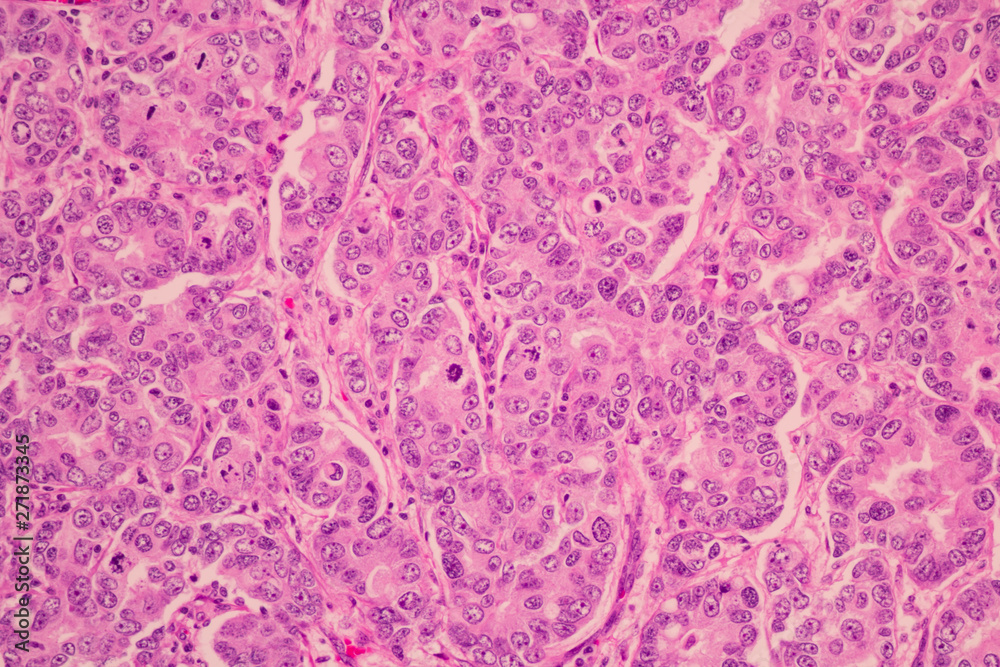 Section tissue of breast cancer view in microscopy.Ductal cell ... Section tissue of breast cancer view in microscopy.Ductal cell ...