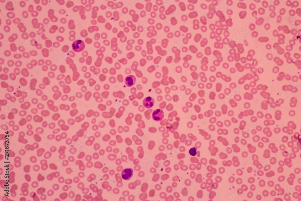 Human blood smear view in microscopy.Complete blood count for treatment ...