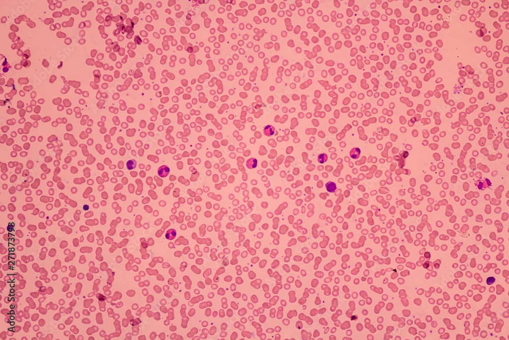 Human blood smear view in microscopy.Complete blood count for treatment ...