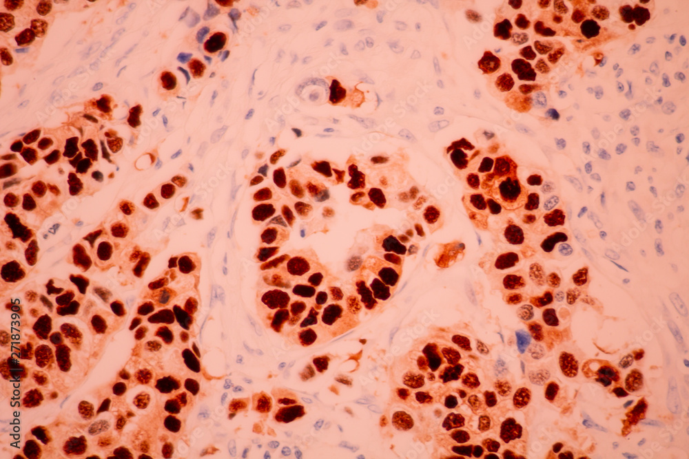 View in microscopic of pathology cross section tissue ductal cell ...