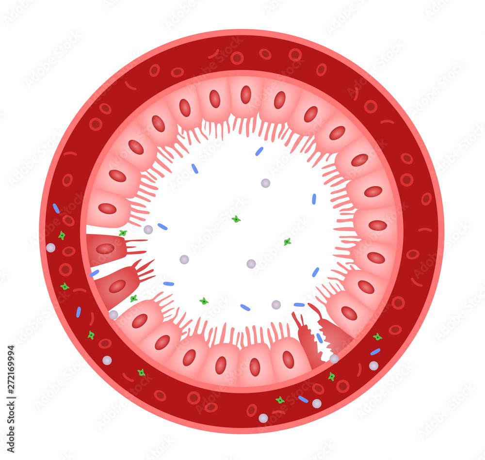 Celiac disease Small intestine lining damage. good and damaged villi ...