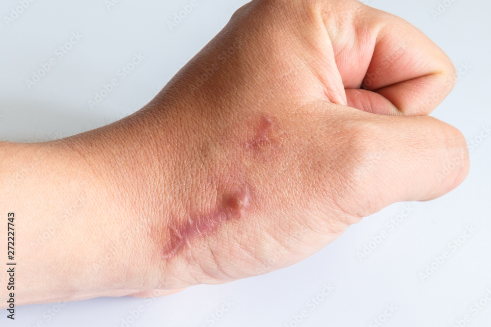 The scar on his arm near the wrist on a white background. Two scars ...