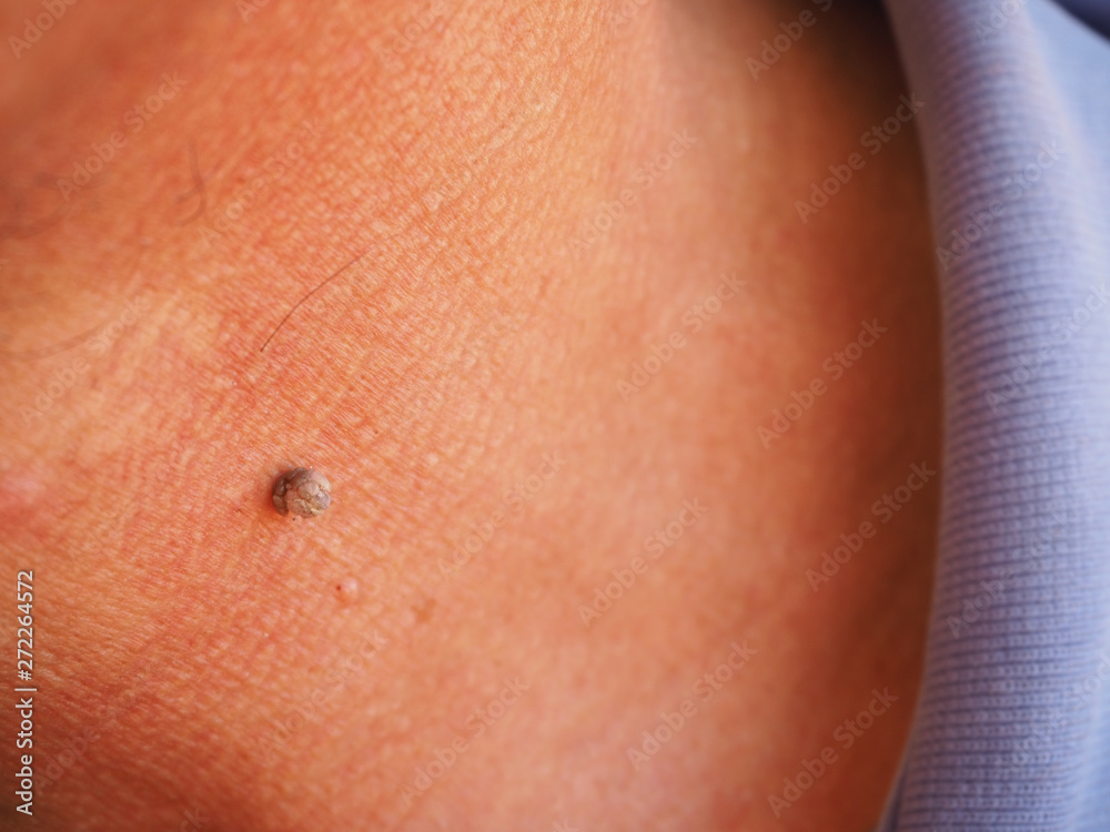 Seborrheic keratoses or verruca senilis on skin neck men and treatment ...