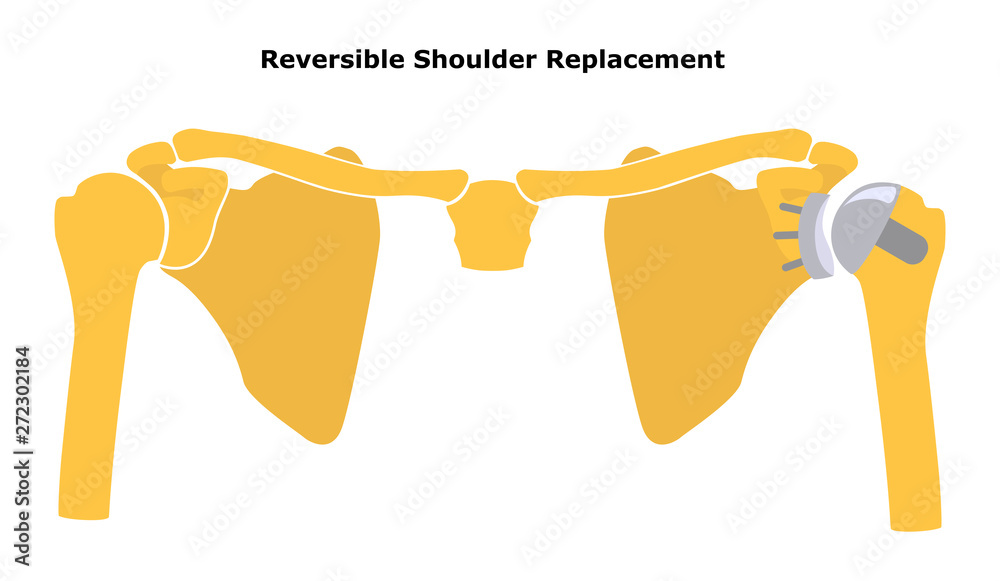 Reversible Shoulder Replacement Shoulder Joint Replacement reversible-shoulder-replacement-shoulder-joint-replacement