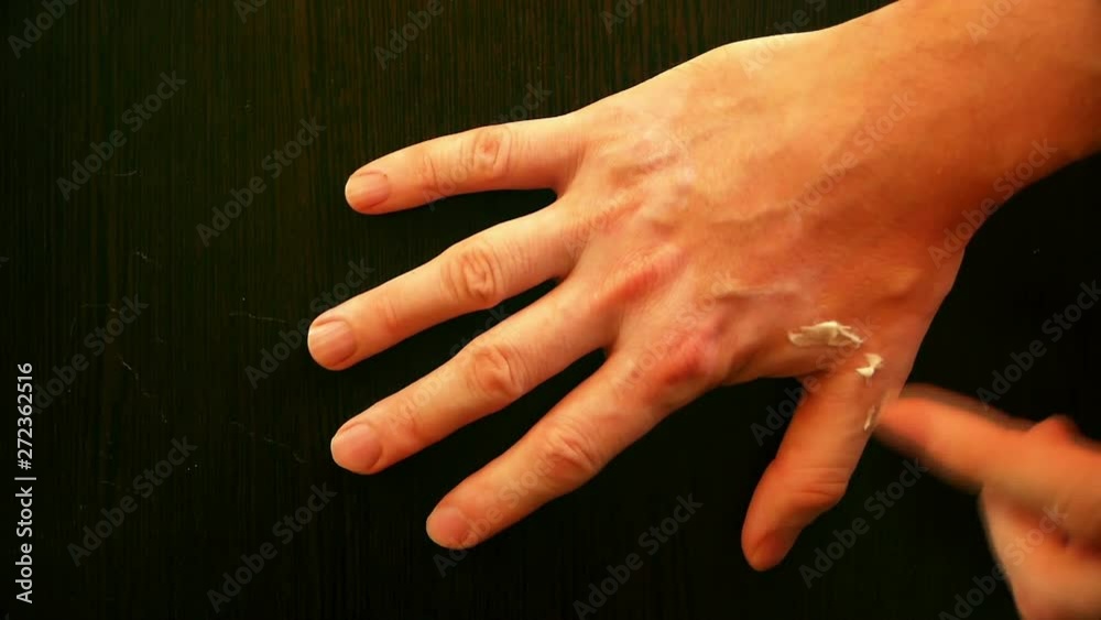 Video Stock close up of the hand with white spots on the skin of ...
