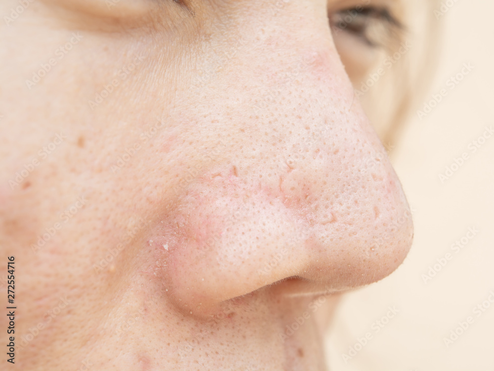 Acne scars and pores. In the nose Black spots, wrinkles and skin ...