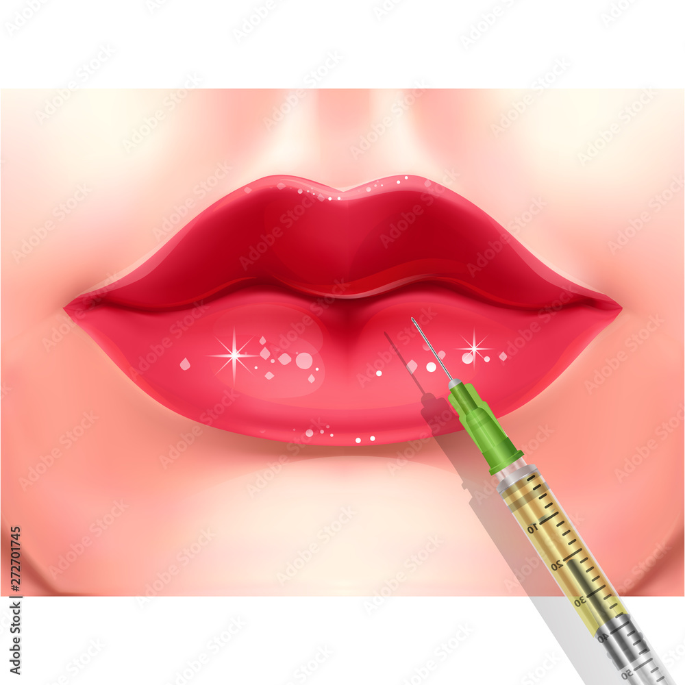 Lips injection, Lip Augmentation. injectable cosmetic filler. Vector ...