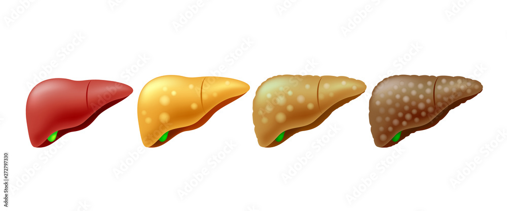 Stages of liver damage. Liver Disease. Healthy, fatty, fibrosis and ...
