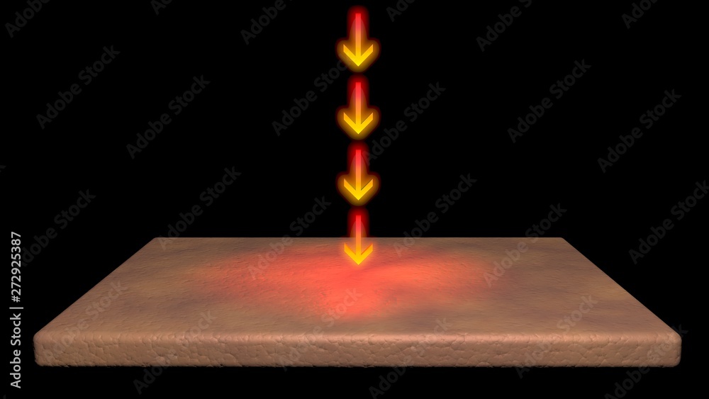 Ultraviolet light rays penetrate surface of skin . Sunburn , scorched ...