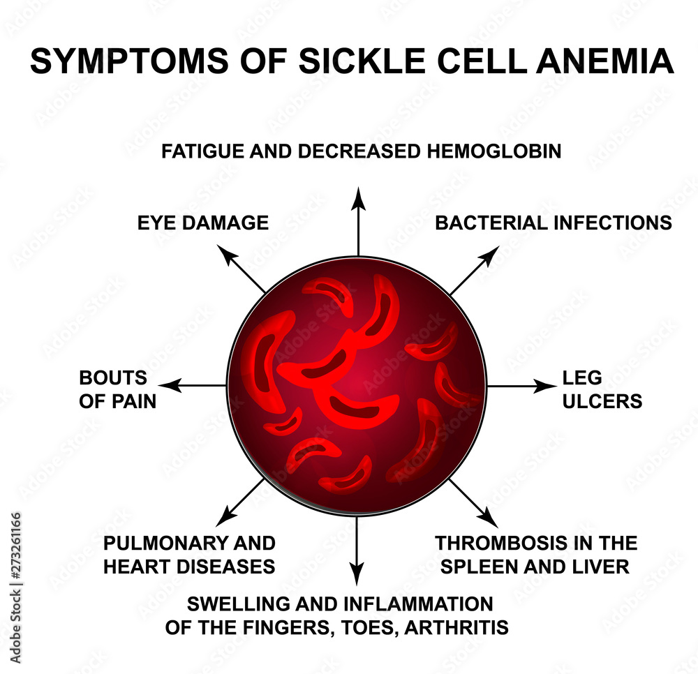 Symptoms of sickle cell anemia. World Sickle Cell Anemia Day 19 June ...