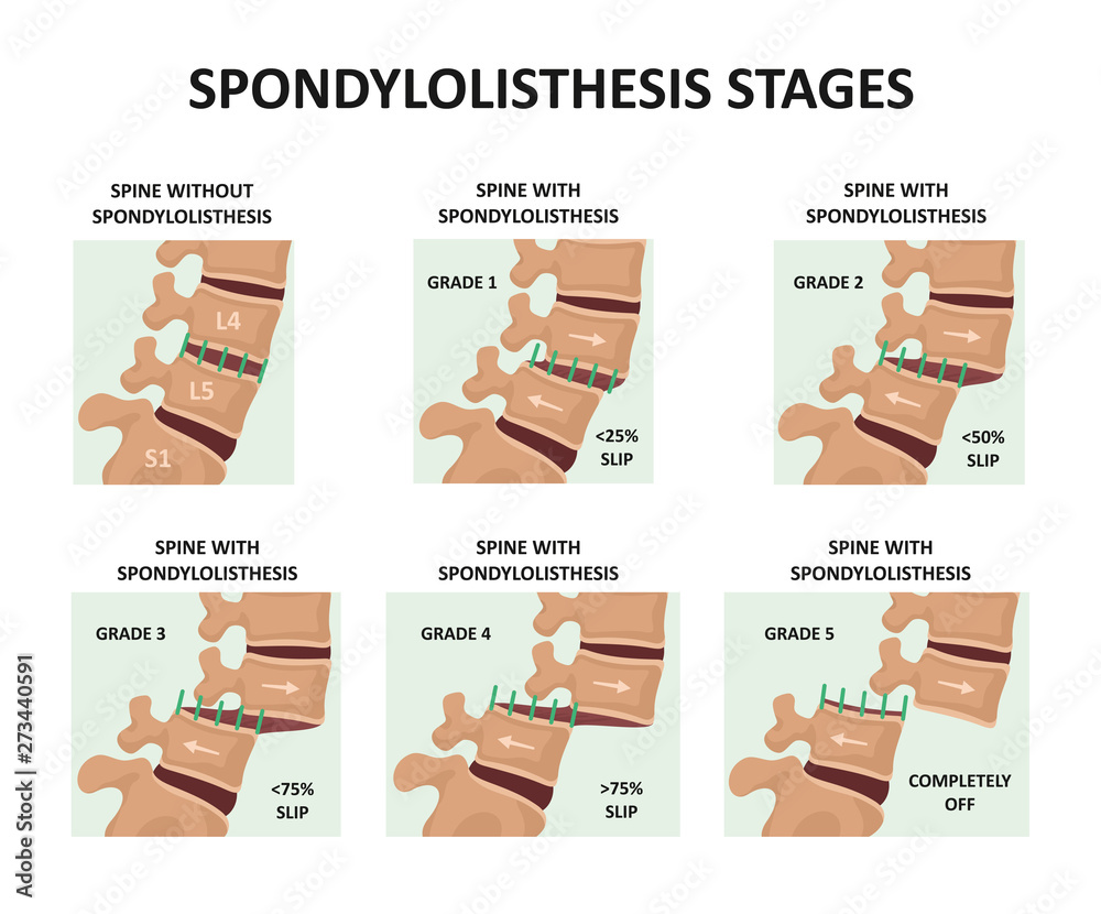 Spondylolisthesis stages Stock Vector | Adobe Stock
