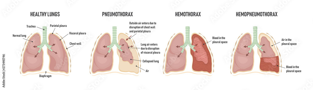 Human lungs with pneumothorax, hemothorax and hemopneumothorax Stock ...