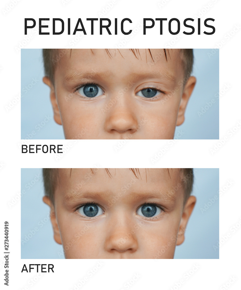Pediatric ptosis. Eye of a child with ptosis of the upper eyelid ...