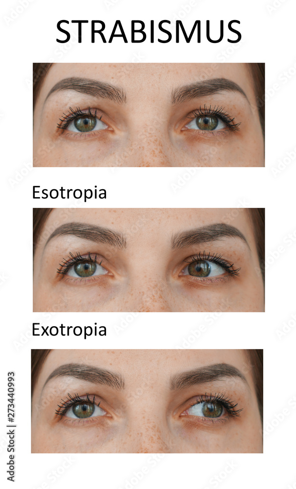 Types of Strabismus. Esotropia and exotropia Stock Photo | Adobe Stock