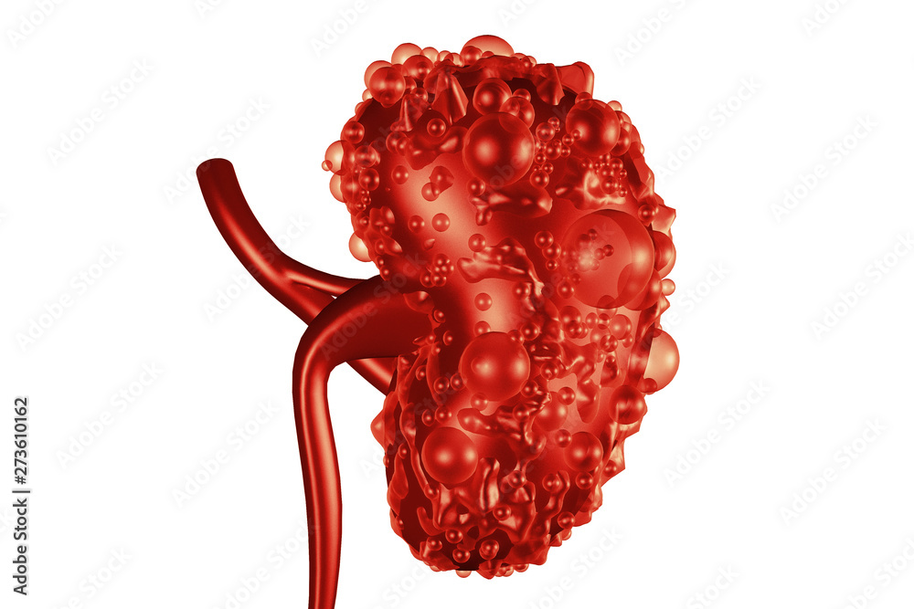 Kidney disease. Kidney cross section Stock Illustration | Adobe Stock